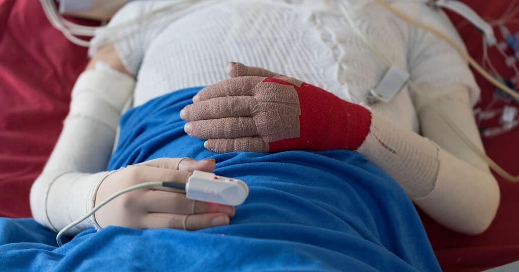 Brandopfer: Viel höhere Überlebenschancen dank moderner ...